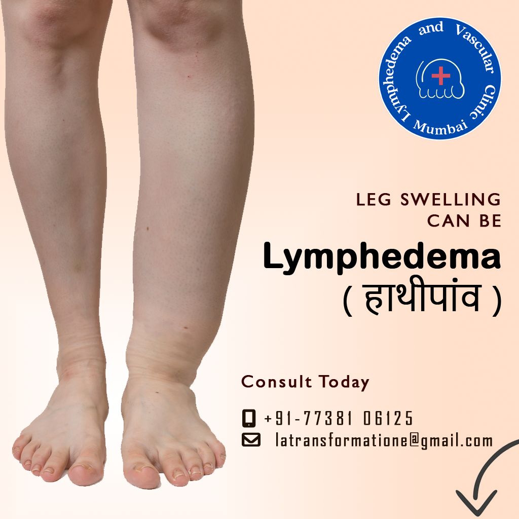 Dr. Anshuman Manaswi on LinkedIn: #lymphedema #lymphatic #lymphaticsystem Dr. Anshuman Manaswi on LinkedIn: #lymphedema #lymphatic #lymphaticsystem