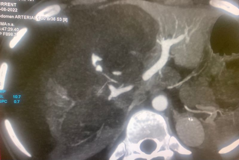Case of RTA with liver lacerations and active bleeding 🩸 from hepatic ... Case of RTA with liver lacerations and active bleeding 🩸 from hepatic ...