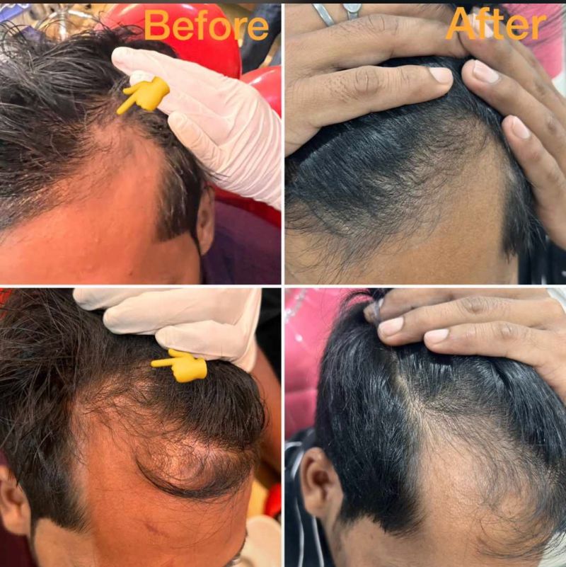 Dr. Akshara Shaji auf LinkedIn: Results of hair prp , just after 28days ... Dr. Akshara Shaji auf LinkedIn: Results of hair prp , just after 28days ...