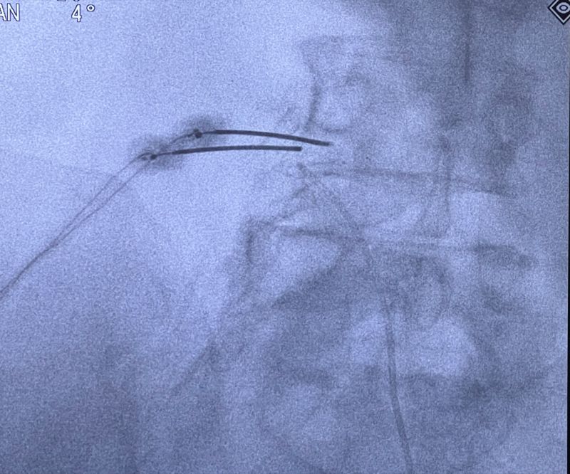 Prof.Dr.Mohammad Yosry en LinkedIn: Bipolar pulsed RF for left L4-5 ... Prof.Dr.Mohammad Yosry en LinkedIn: Bipolar pulsed RF for left L4-5 ...