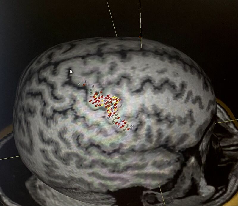 Nexstim on LinkedIn: #Buckeye #neurosurgery #ntms Nexstim on LinkedIn: #Buckeye #neurosurgery #ntms