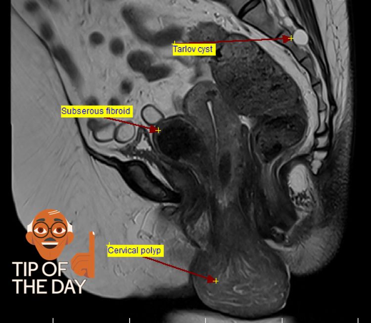 Mohamed Shemais on LinkedIn: #female_imaging #giant_cervical_polyp # ... Mohamed Shemais on LinkedIn: #female_imaging #giant_cervical_polyp # ...