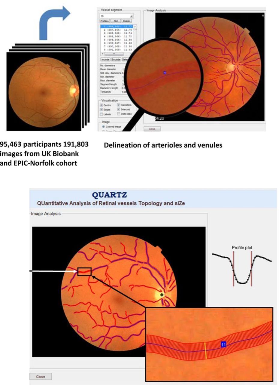 National Eye Institute (NEI) on LinkedIn: Researchers from St George's ... National Eye Institute (NEI) on LinkedIn: Researchers from St George's ...