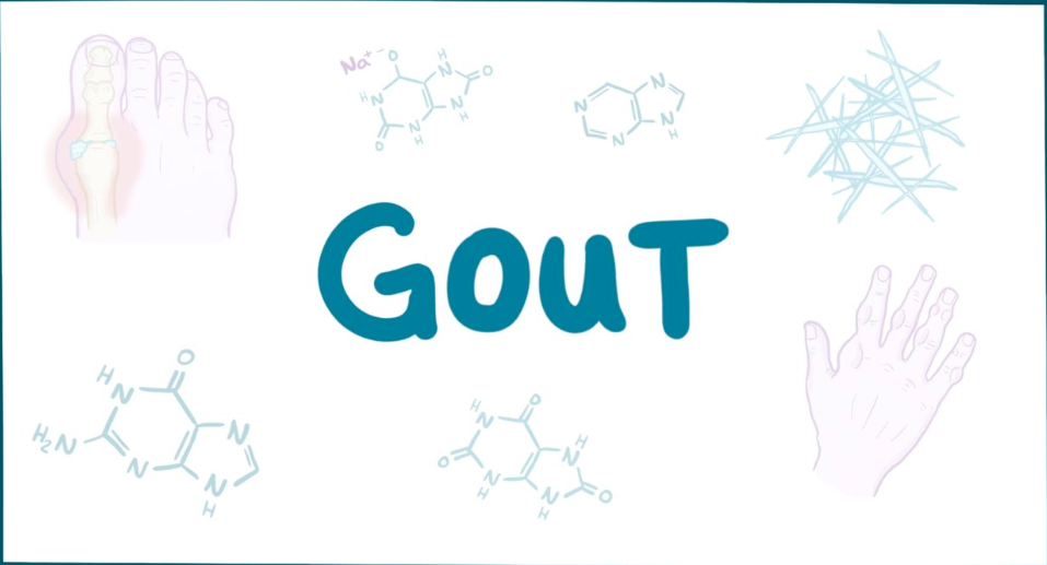 Gout-Causes, Symptoms, Diagnosis, Treatment and Pathology Gout-Causes, Symptoms, Diagnosis, Treatment and Pathology